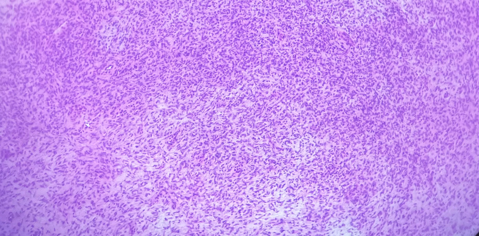 FIBROXANTOMA ATÍPICO - Dermatofibrosarcoma
